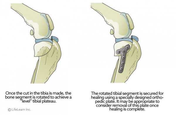 Cranial Cruciate Ligament Repair: Tibial Plateau Leveling Osteotomy ...