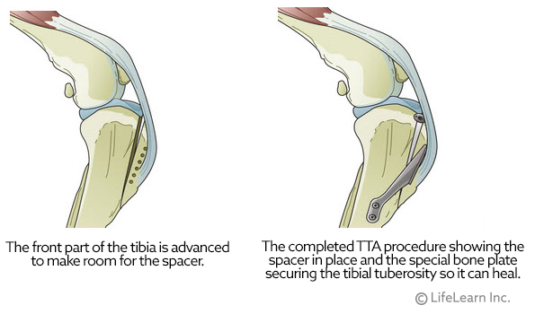 Cranial Cruciate Ligament Repair: Tibial Tuberosity Advancement (TTA ...