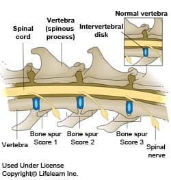 Spondylosis Deformans in Dogs | VCA Animal Hospital