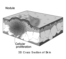 Cutaneous Histiocytoma in Dogs | VCA Animal Hospital